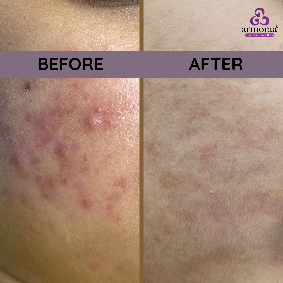 Collagen induction - Armoraa